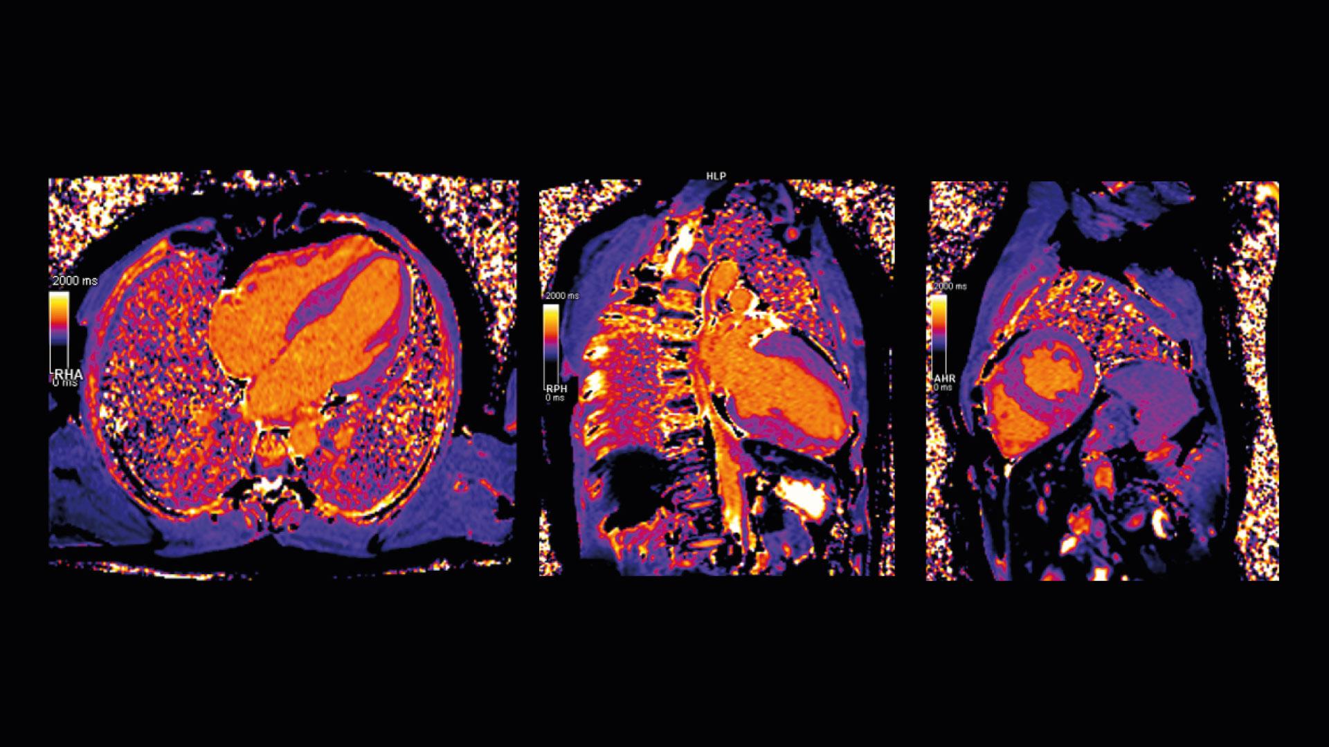 Fibrosis miocárdica: CRM sin electrodos de ECG - Siemens Healthineers ...