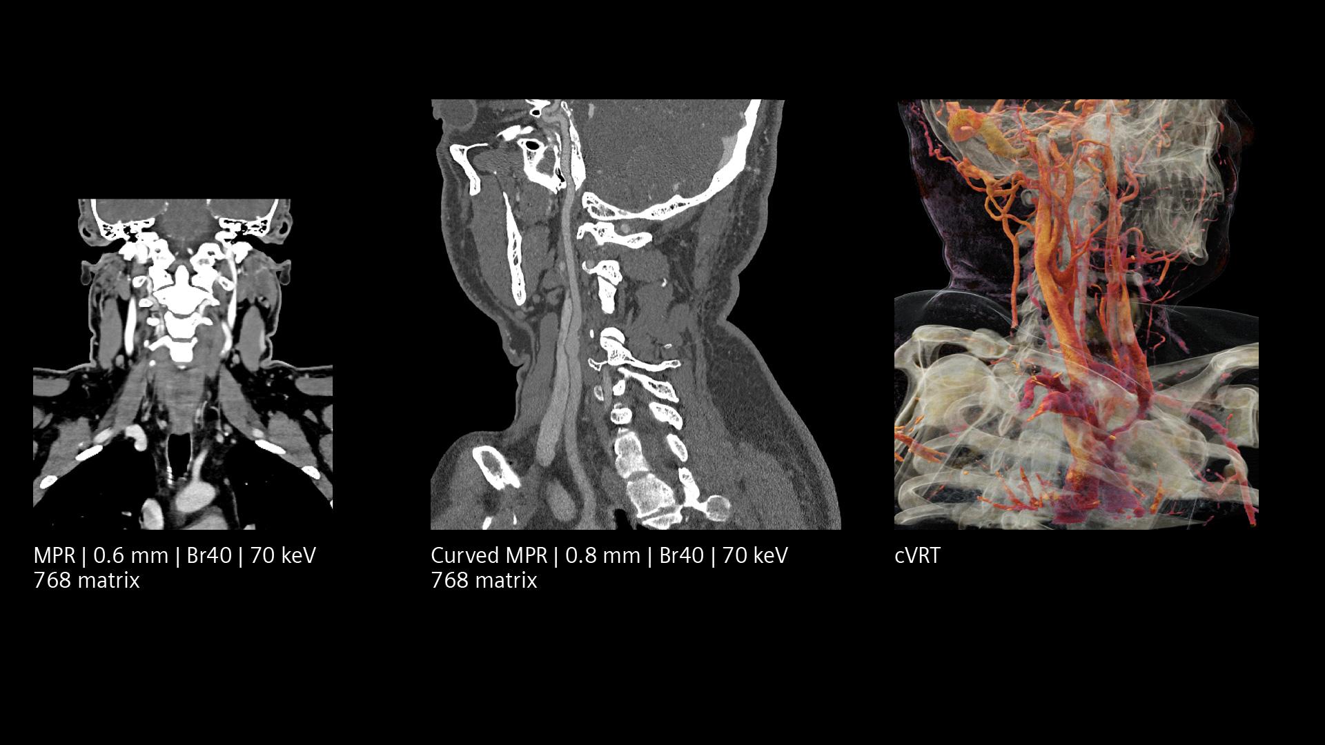 PCCT neurology imaging - Siemens Healthineers