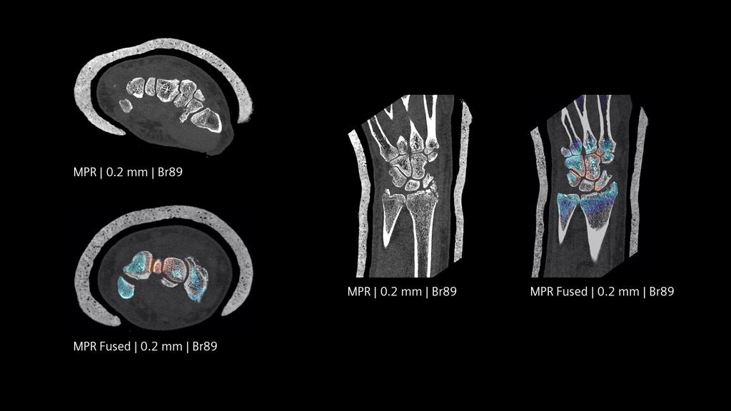 Photon-counting CT musculoskeletal imaging - Siemens Healthineers