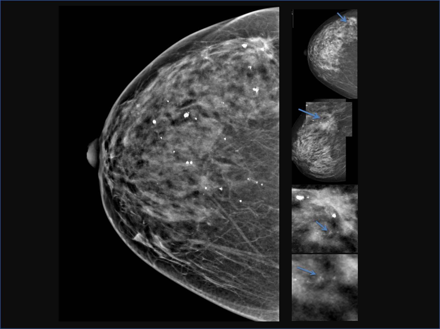 Titanium Contrast Enhanced Mammography (TiCEM) with 50° Wide-Angle HD ...
