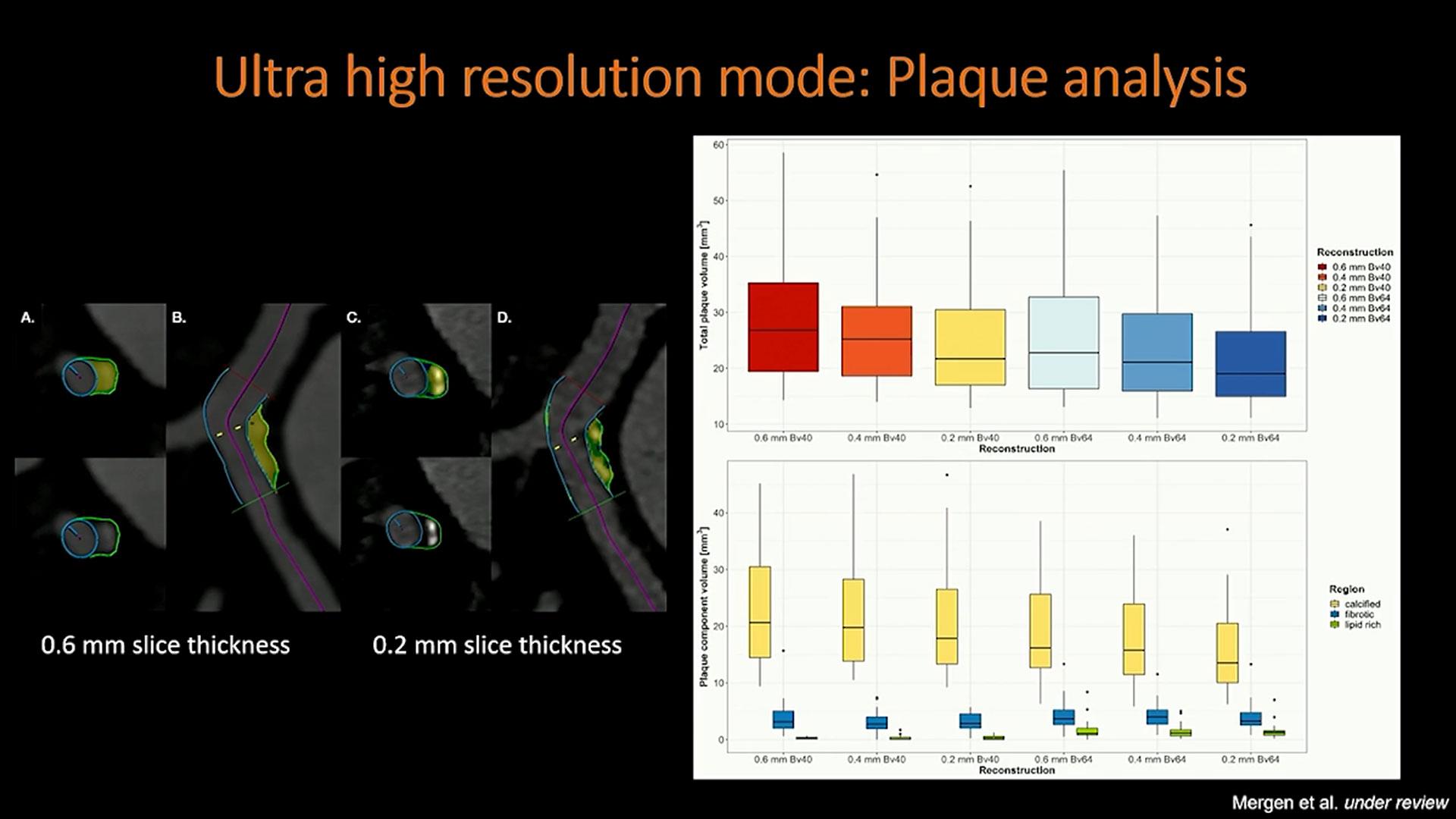 Photon Counting Ct And Its Added Value In Cardiovascular Imaging