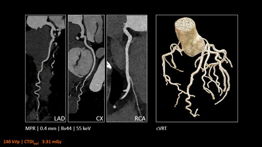 Dual Source CT - Siemens Healthineers
