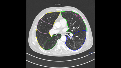 AI-Rad Companion - Siemens Healthineers USA