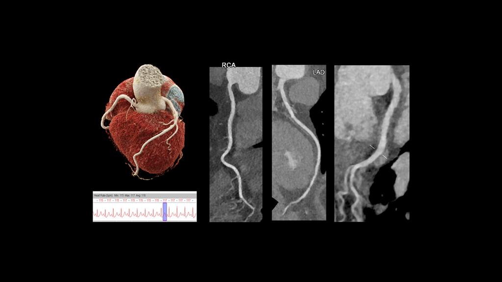 CT Cardiovascular imaging - Siemens Healthineers