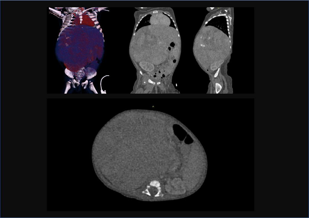 Ultra-Low Dose Free Breathing Pediatric CT Imaging