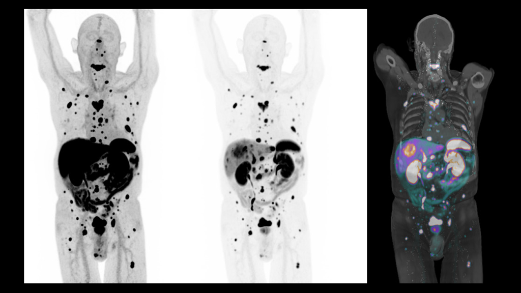 Single bed Whole body 68Ga DOTATATE PET CT Delineation Of Single bed Whole body 68Ga DOTATATE PET CT Delineation Of