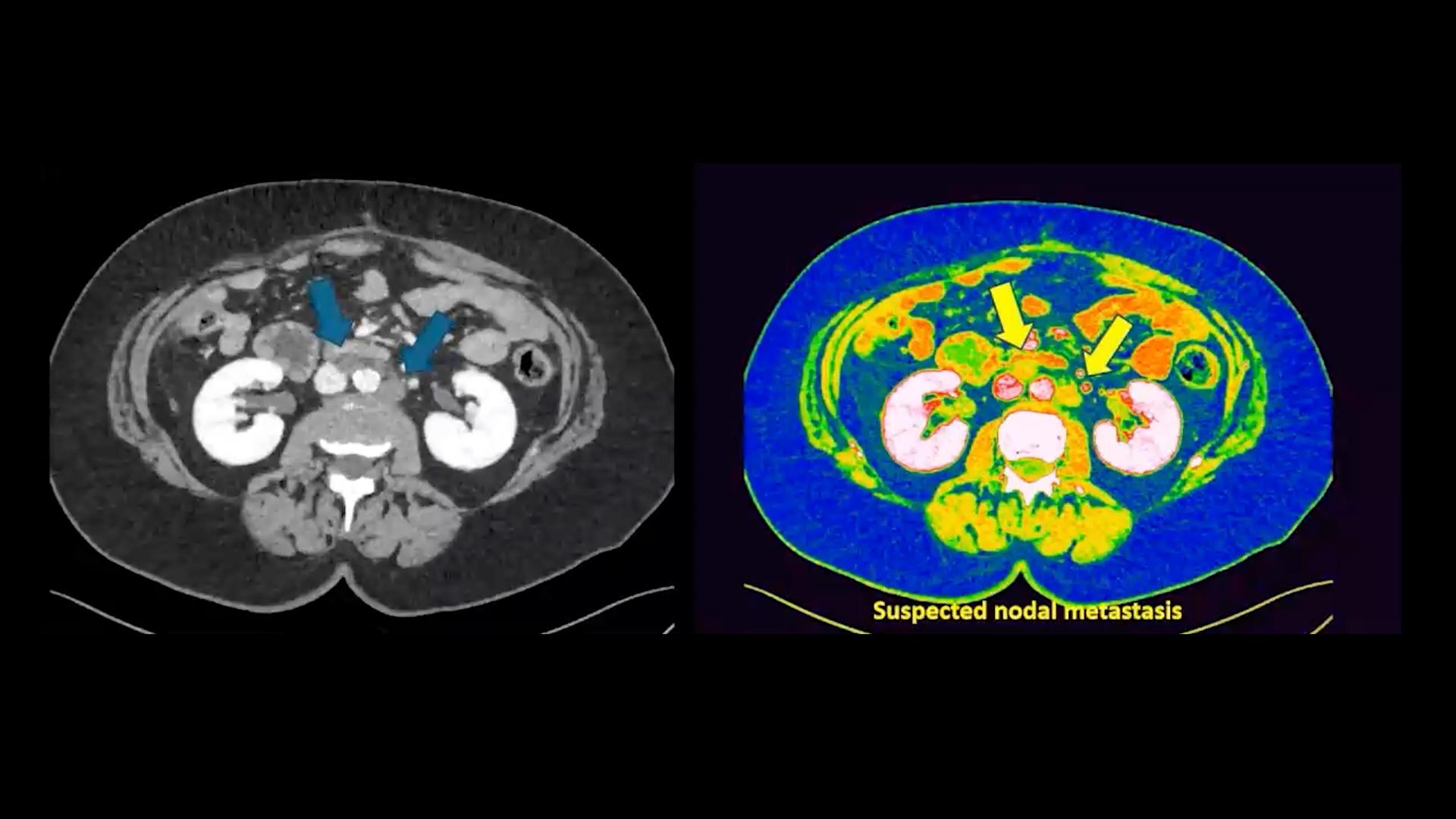 At the forefront of imaging: Expanding photon-counting CT to transform ...