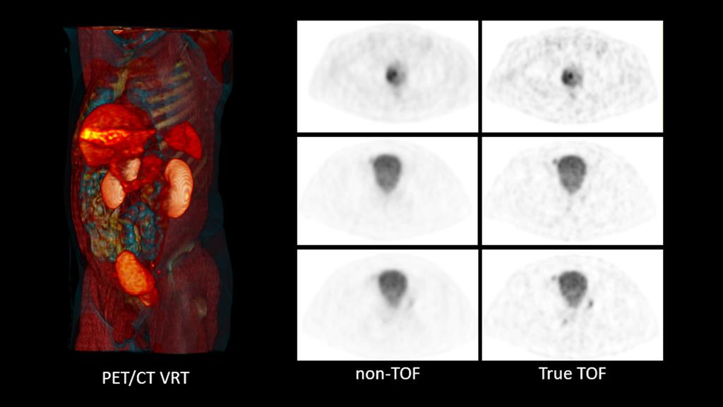 True TOF technology - Siemens Healthineers USA