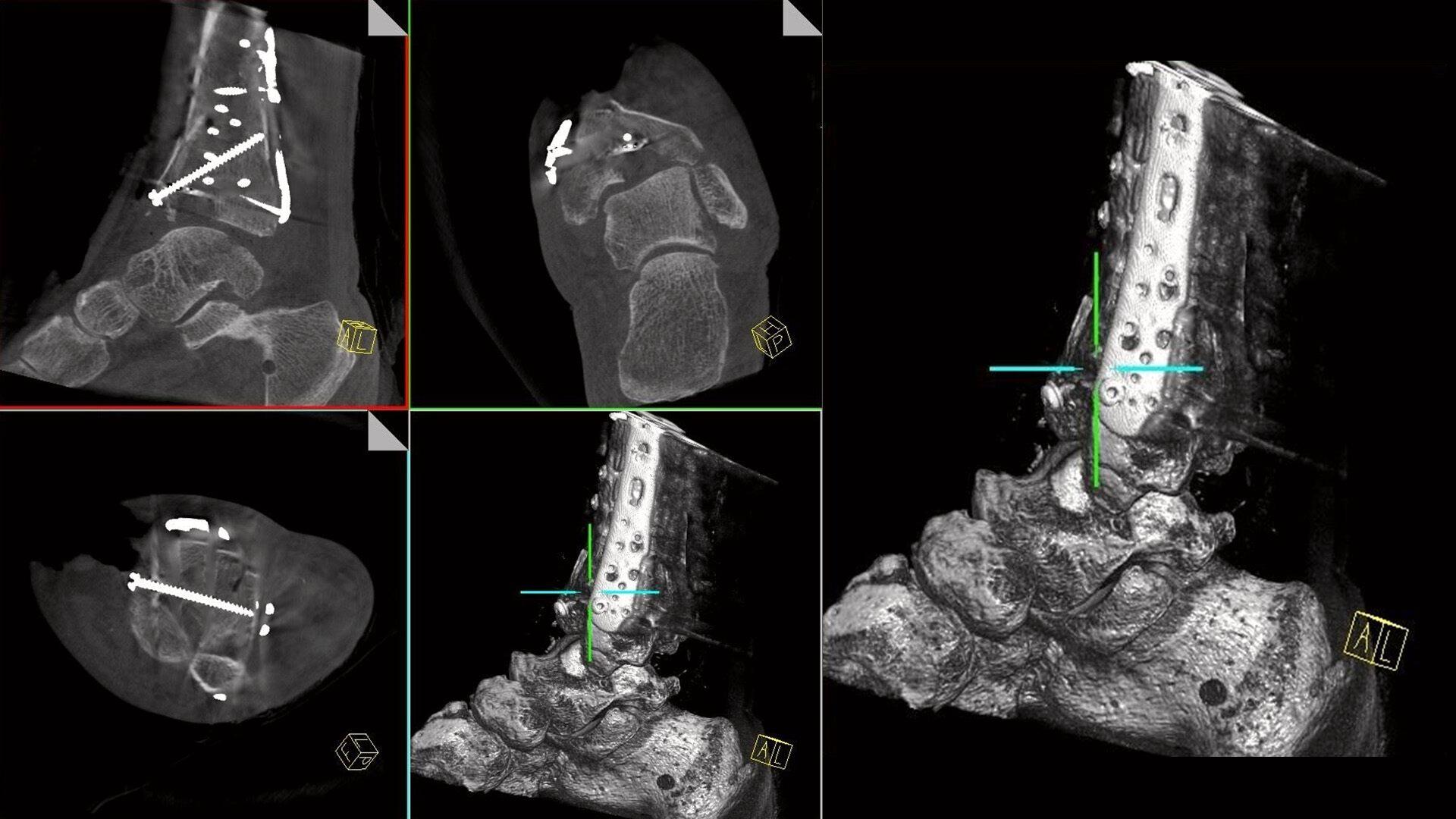Intraoperative 3D imaging in orthopedic trauma surgery - Siemens ...
