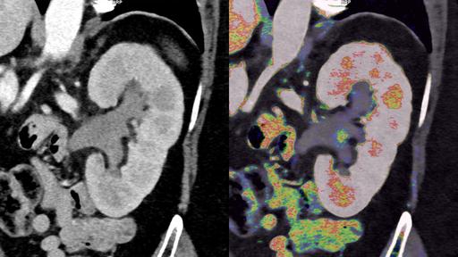 PCCT oncology imaging - Siemens Healthineers
