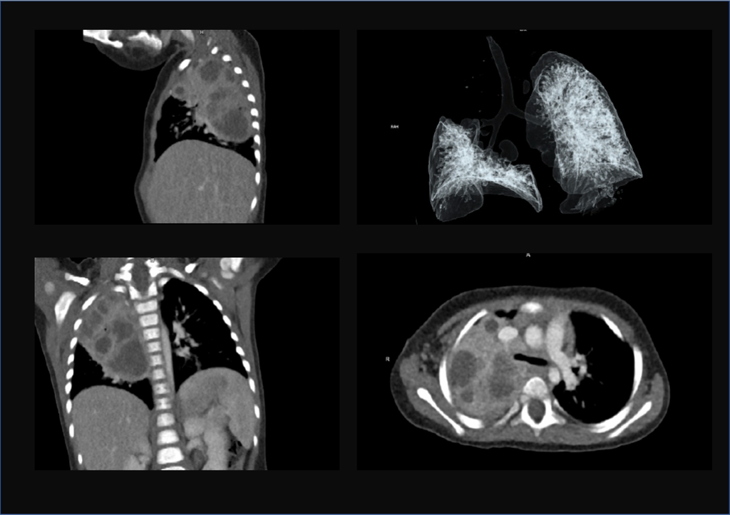 Ultra-Low Dose Free Breathing Pediatric CT Imaging