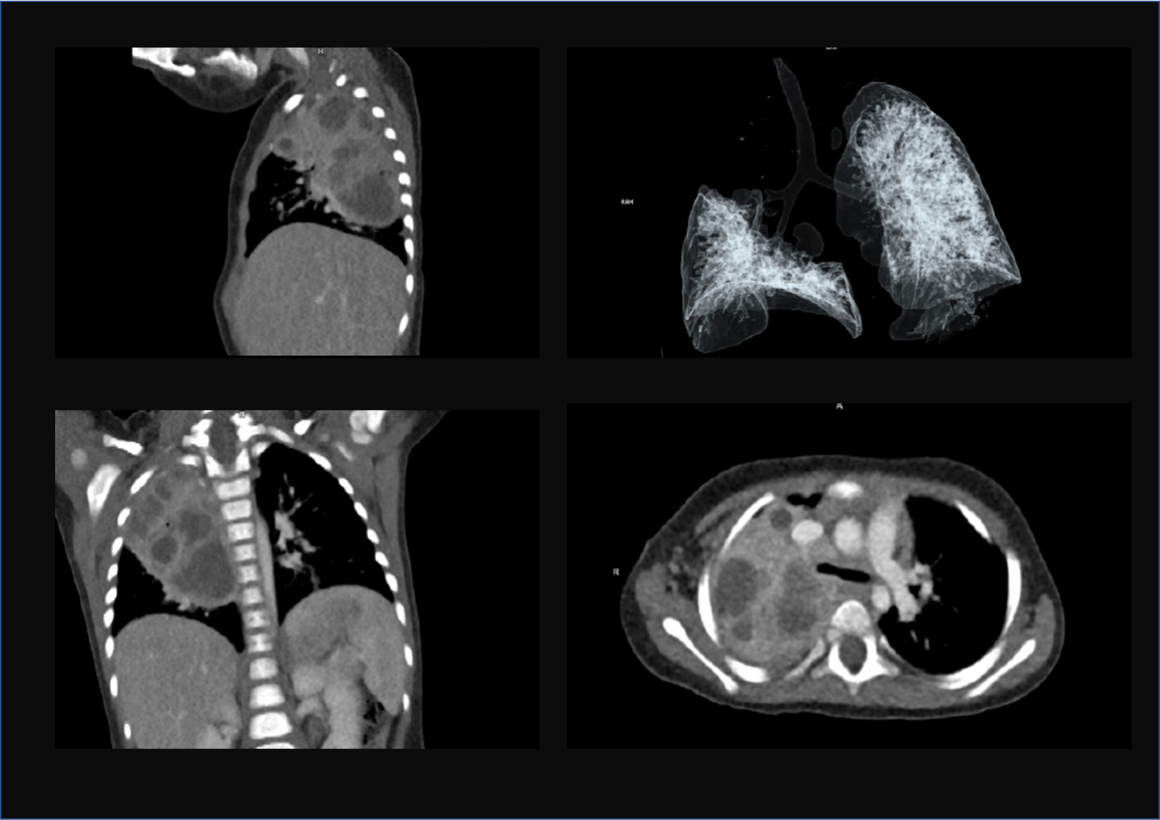 Ultra-Low Dose Free Breathing Pediatric CT Imaging