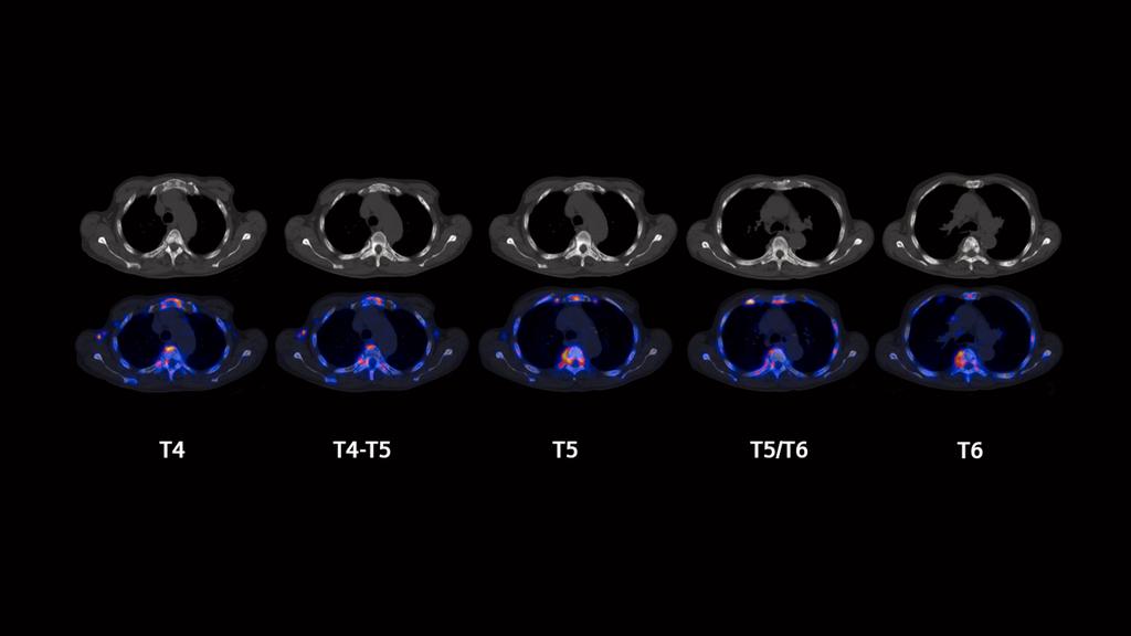 Fast, quantitative SPECT/CT acquisition following multiple therapy ...