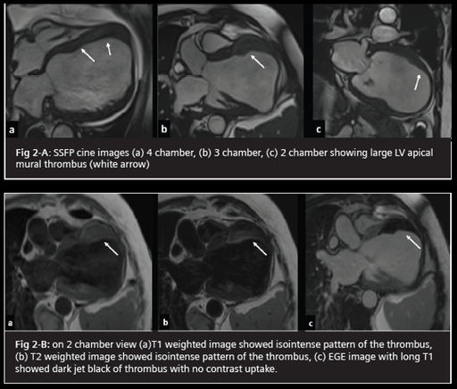 Age determination of the cardiac thrombus: Role of cardiac magnetic ...