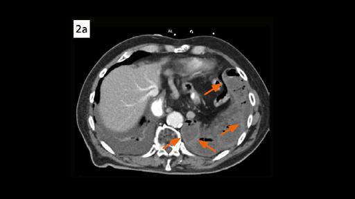Small bowel infarction secondary to an acquired diaphragmatic hernia ...