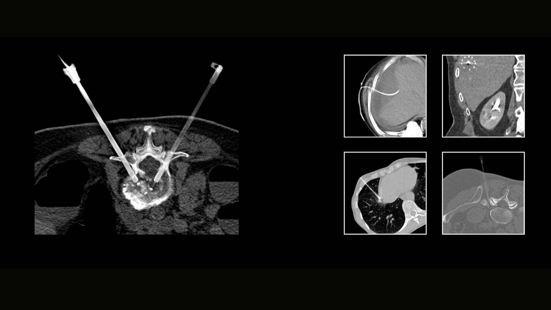 Procedimentos intervencionistas guiados por TC na plataforma SOMATOM go ...