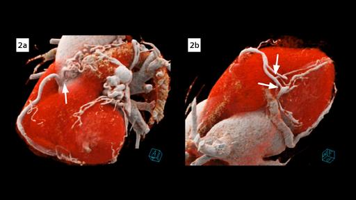 A complex coronary arteriovenous fistula - Siemens Healthineers