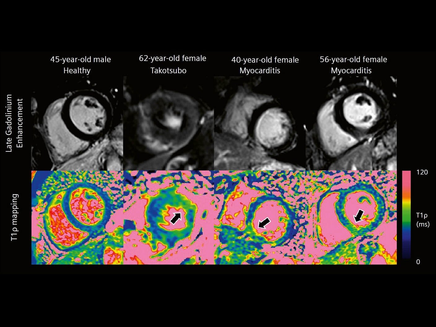 Cardiac Magnetic Resonance T1-rho Mapping at 1.5T