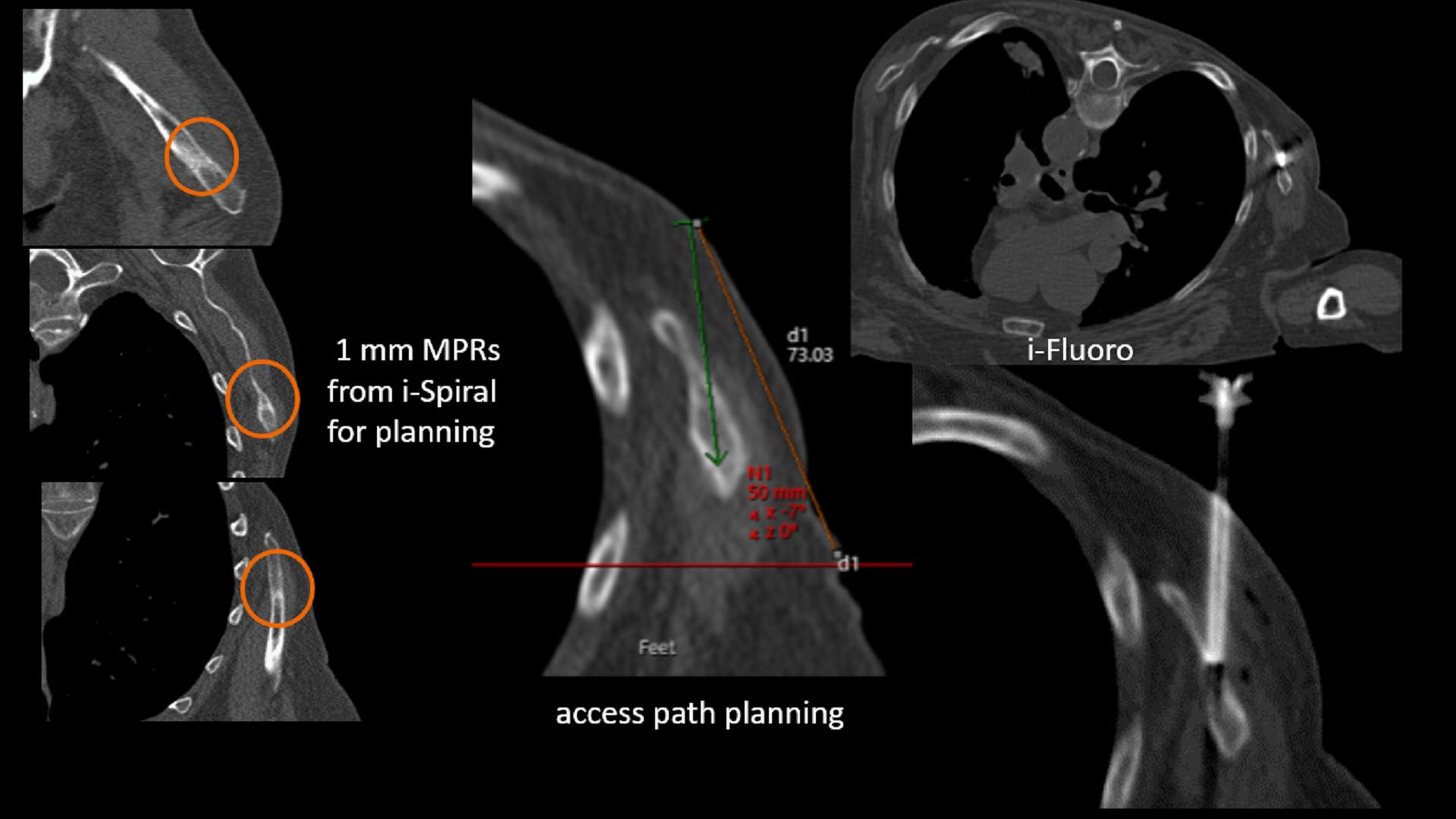 CT-guided interventions - Siemens Healthineers