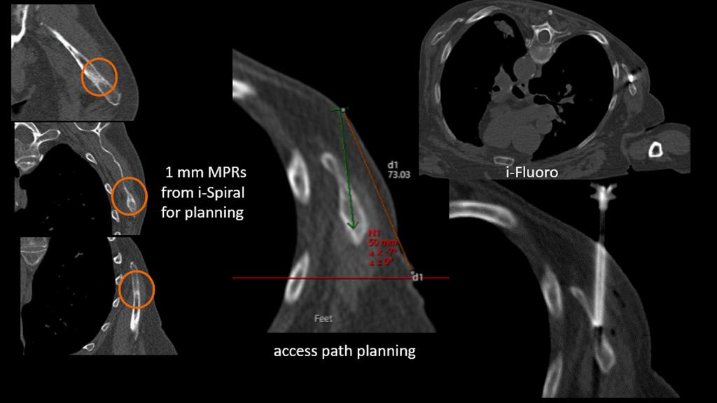 CT-guided interventions - Siemens Healthineers