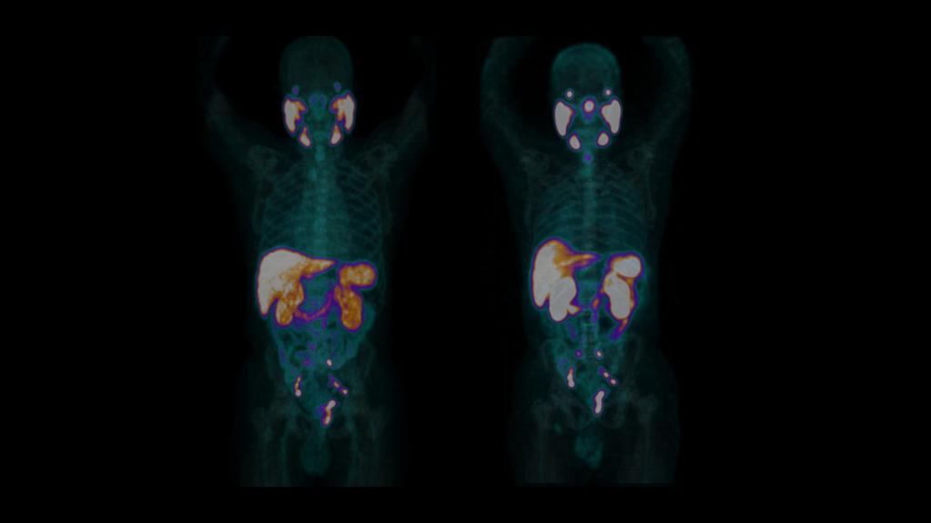 A comparative analysis of 99mTc-iPSMA SPECT/CT and 18F-PSMA-1007 PET/CT