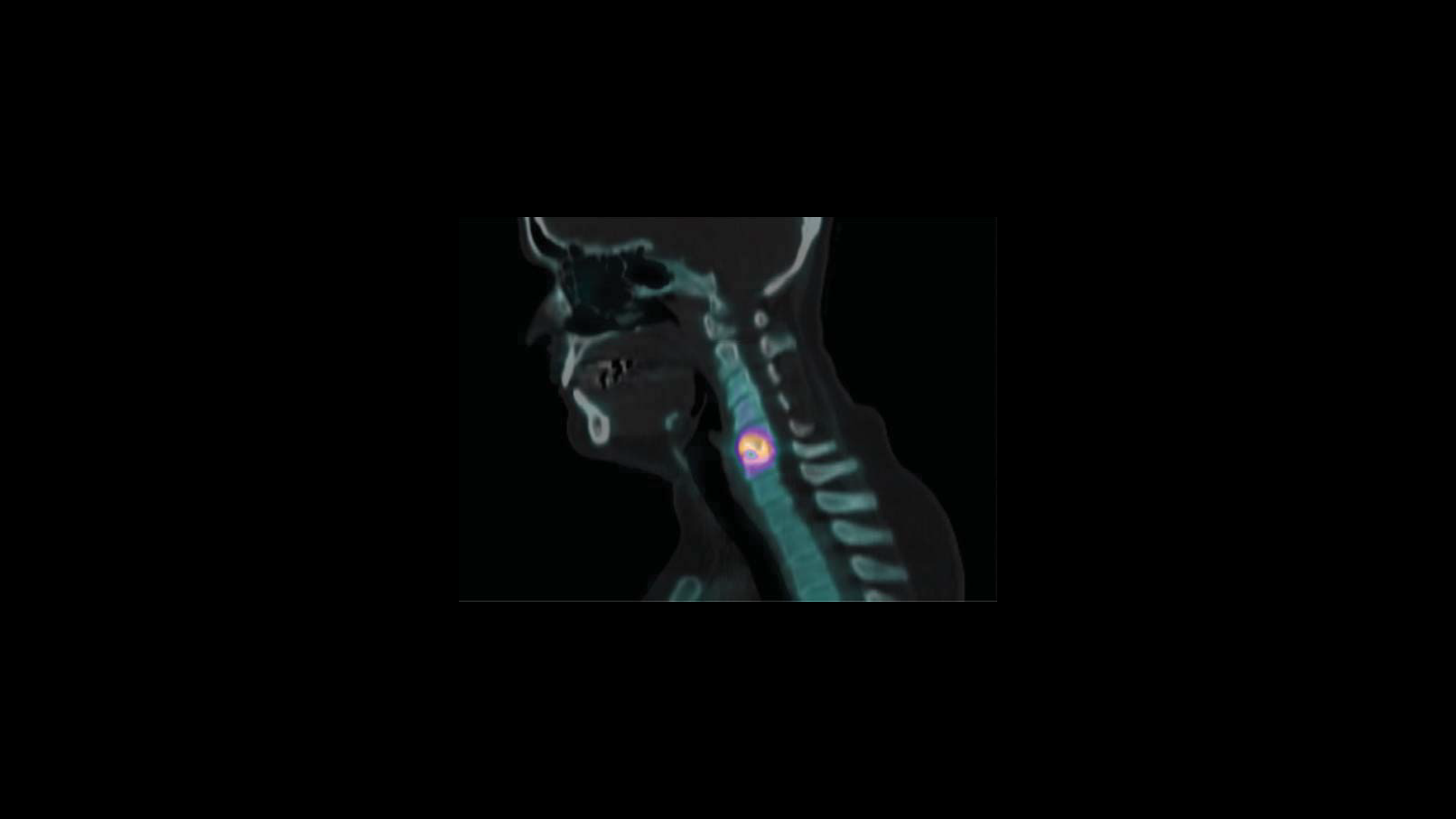 The use of SPECT/CT in a musculoskeletal Physical Medicine and ...