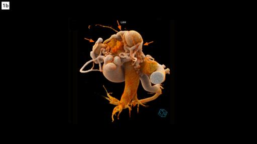 Complex coronary artery fistula - Siemens Healthineers Türkiye