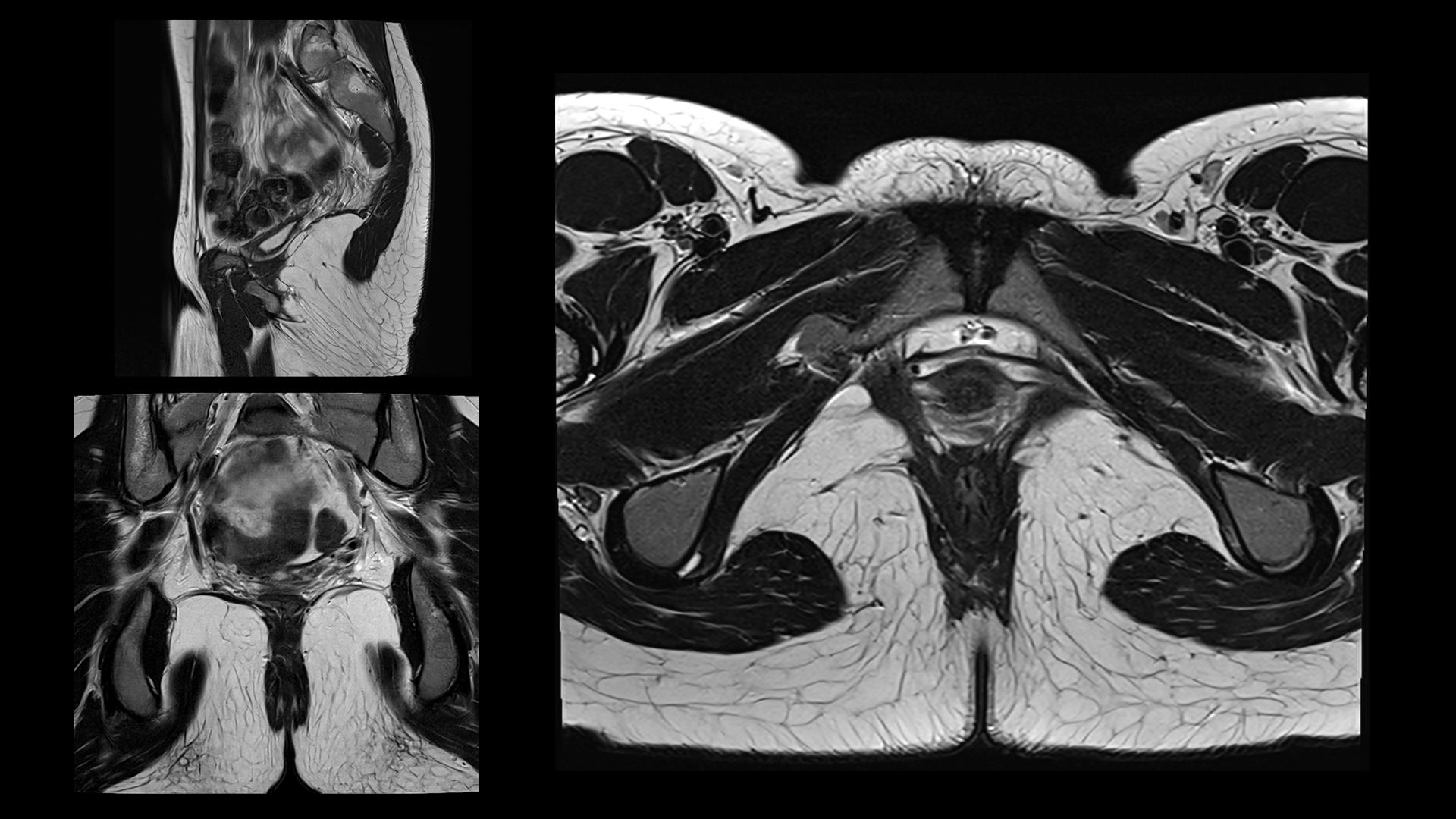 Pediatric protocols using Deep Resolve