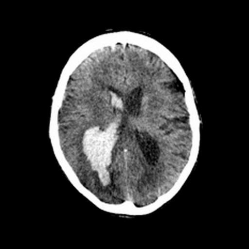 Advanced Stroke Management & Patient Care - Siemens Healthineers USA