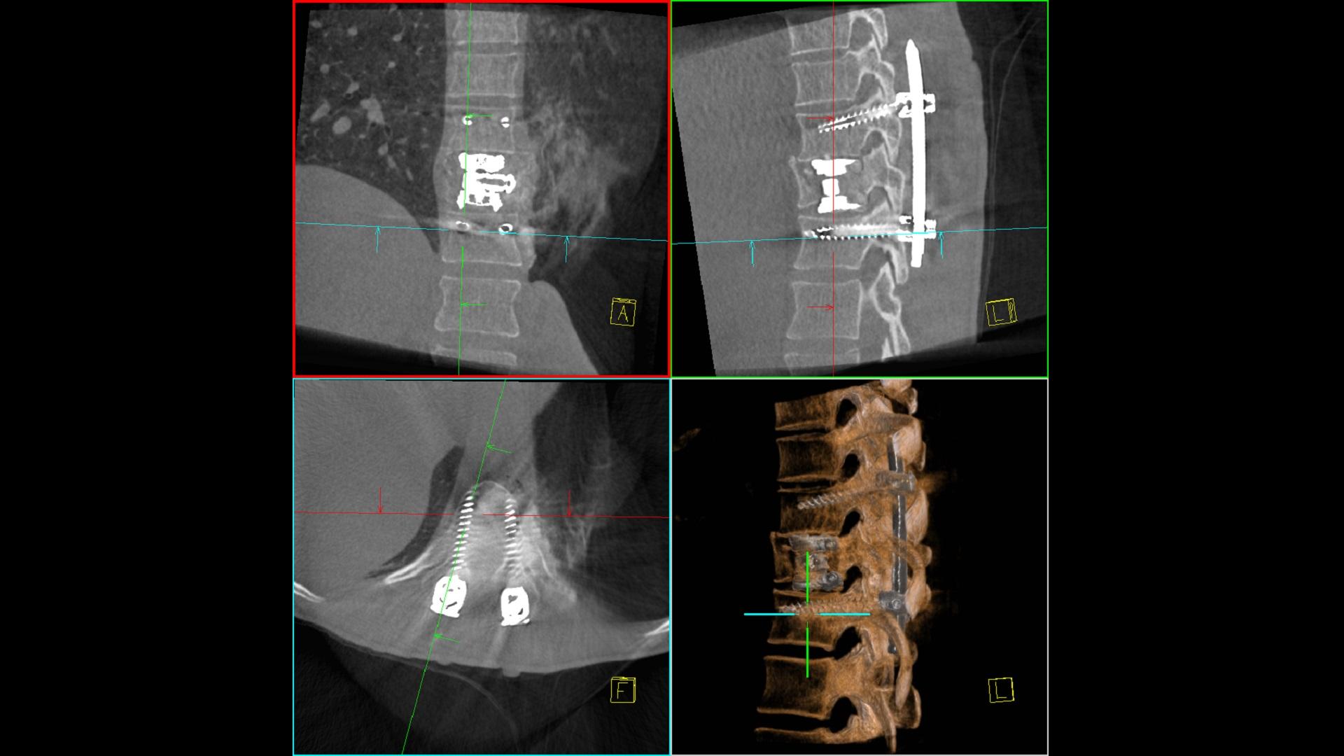 Cios Spin – Mobile C-arm machine - Siemens Healthineers