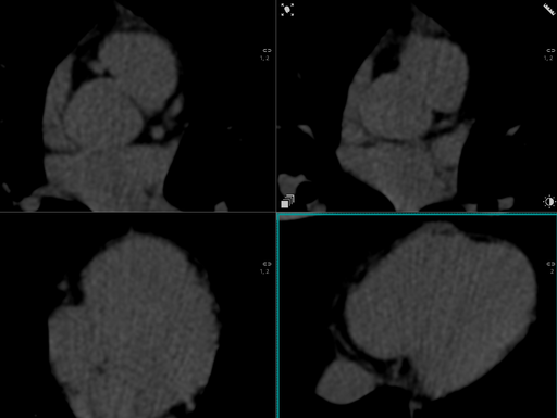 CT calcium scoring: Ultra low dose coronary Ca scoring screening ...