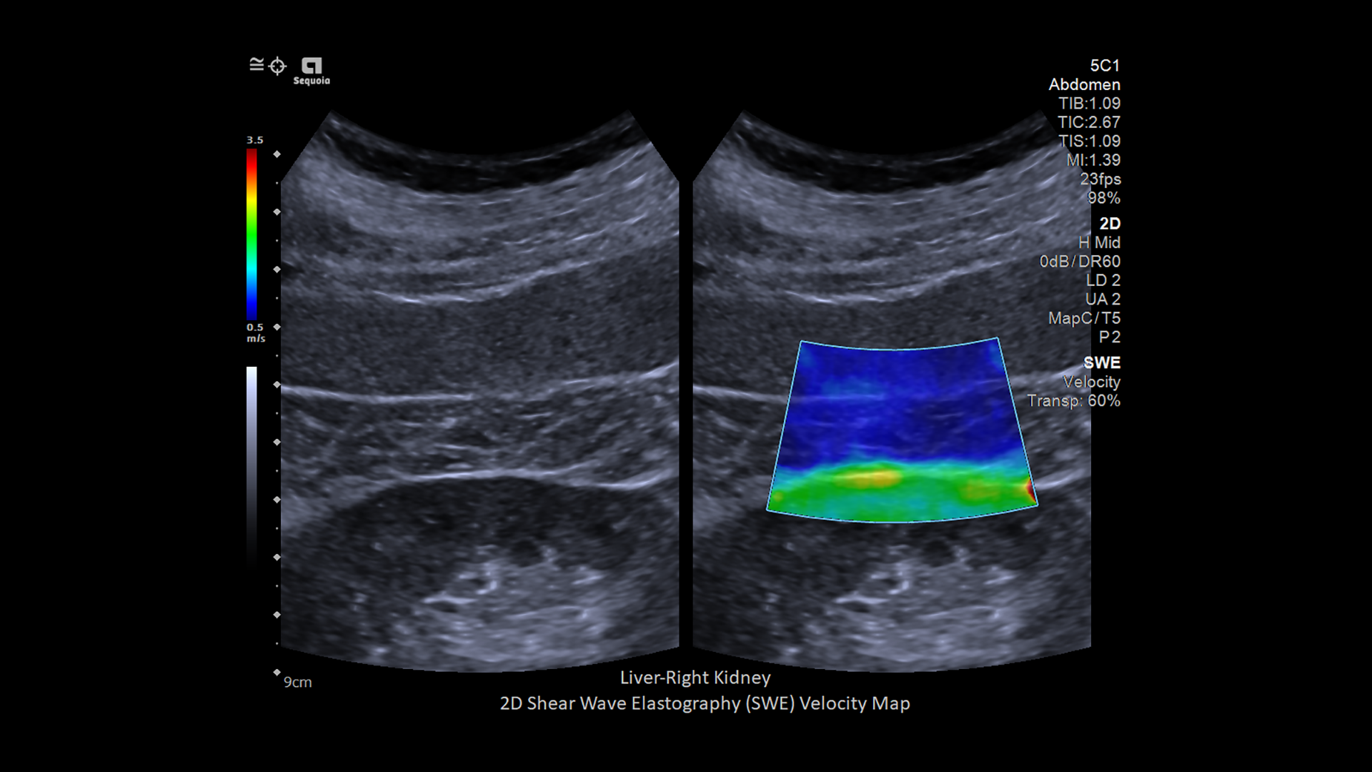 ACUSON Sequoia Ultrasound System - Siemens Healthineers