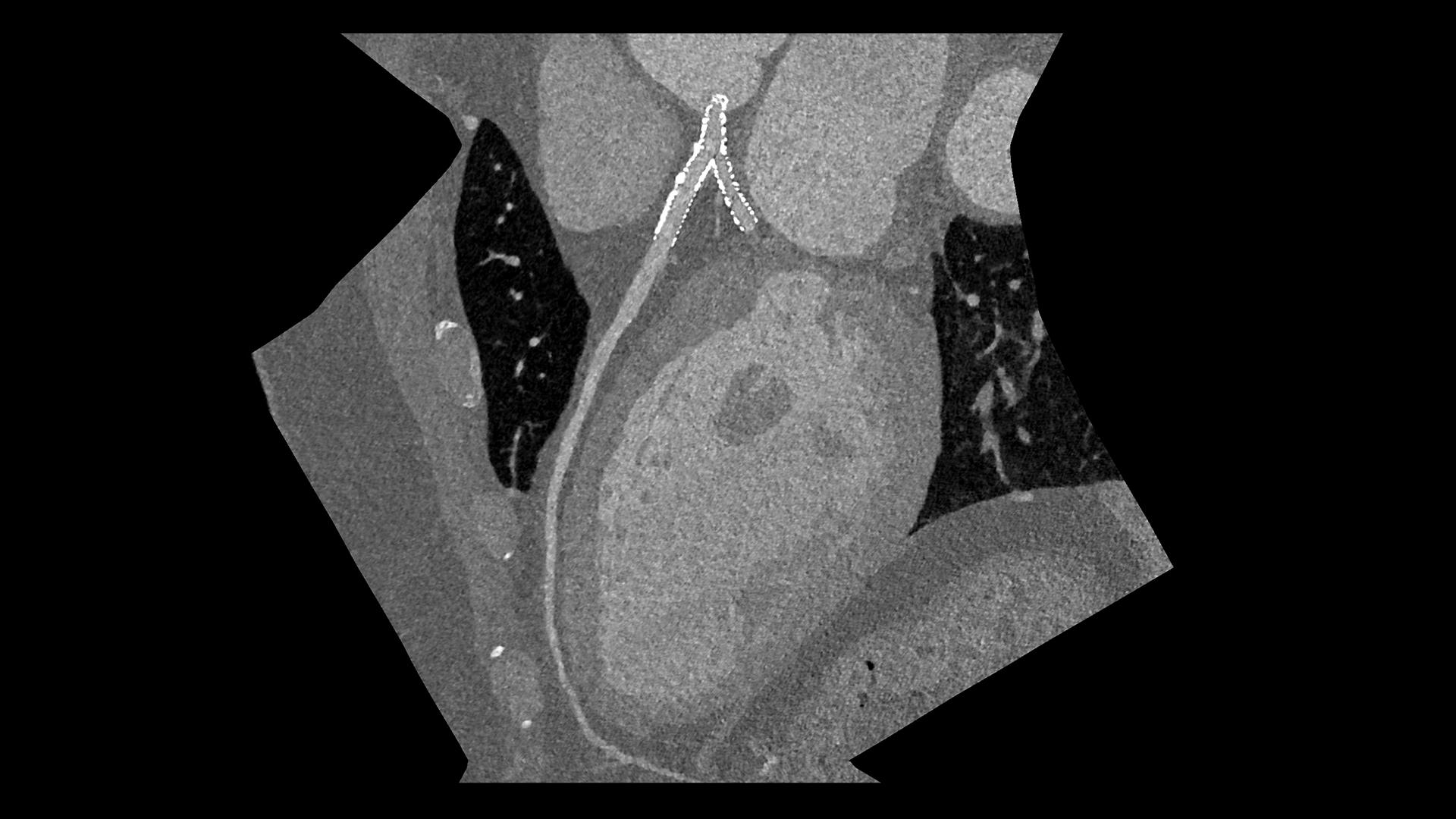PCCT cardiovascular imaging - Siemens Healthineers