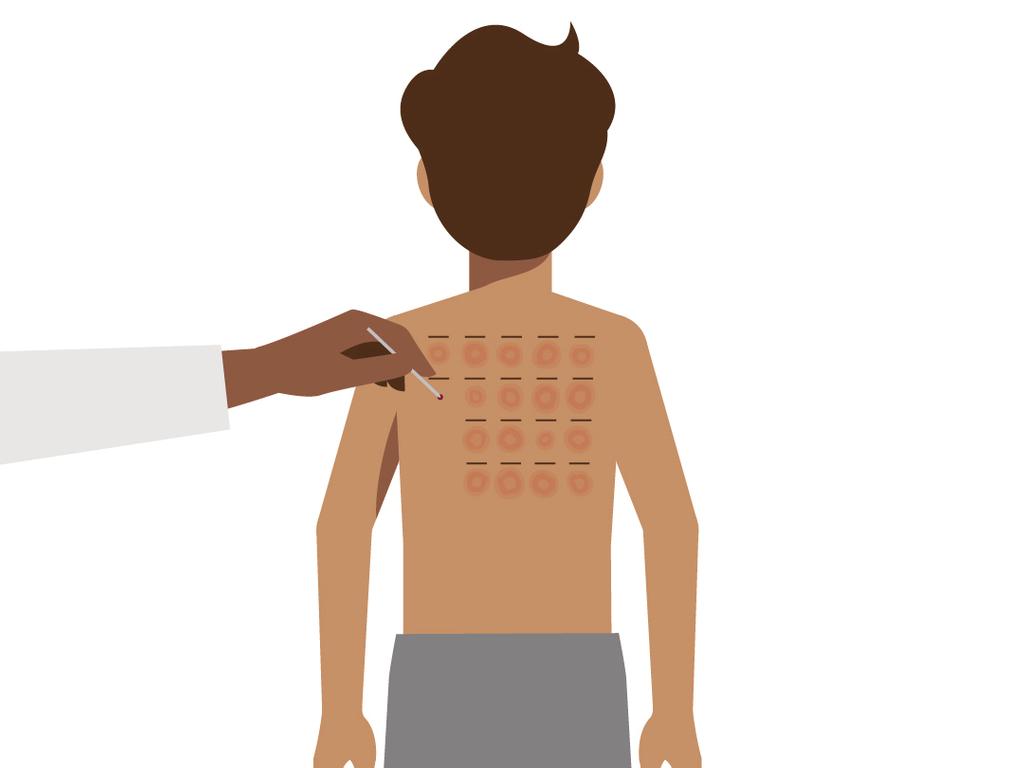 What are allergies? | Patient Information - Siemens Healthineers