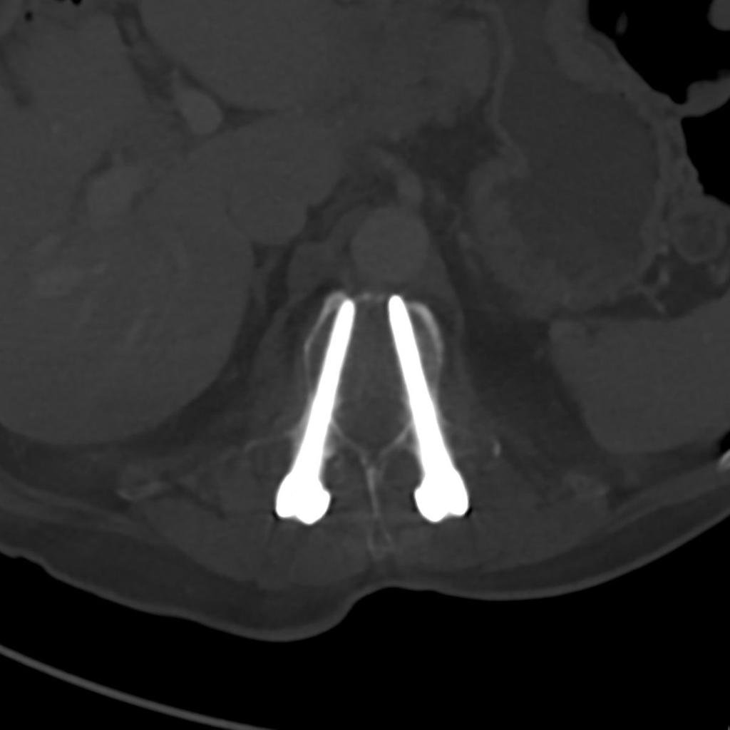 iMAR - Iterative Metal Artifact Reduction - Siemens Healthineers USA