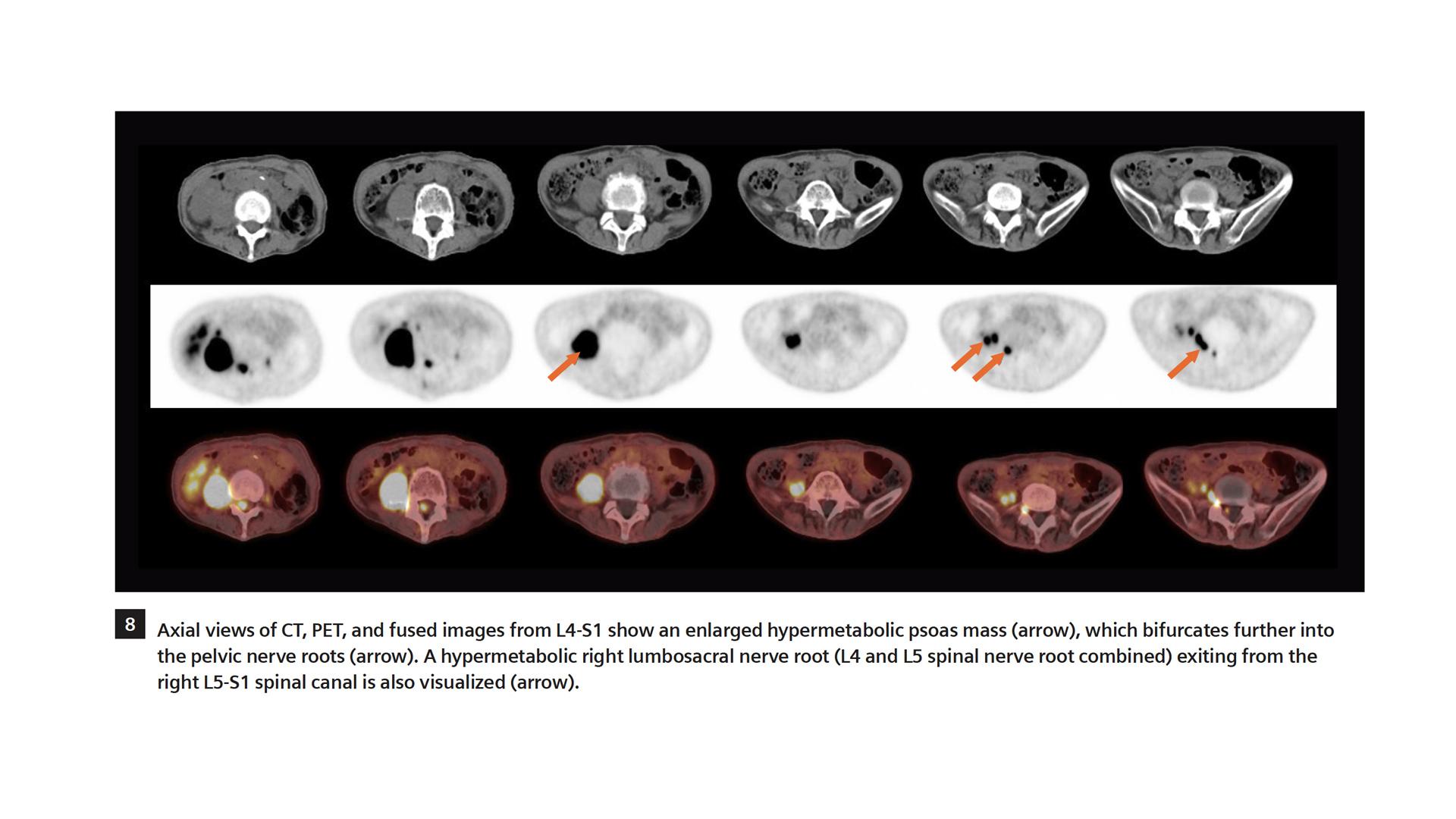 18F FDG PET/CT delineation of diffuse large B-cell lymphoma involving ...