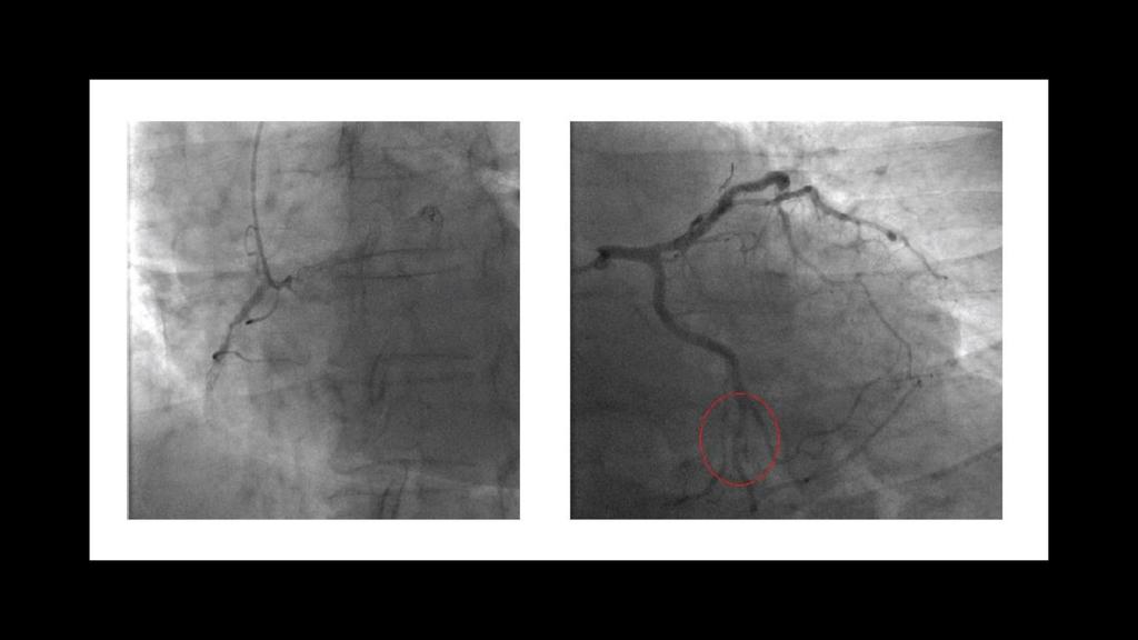 PET/CT delineation of multivessel coronary artery disease and post ...