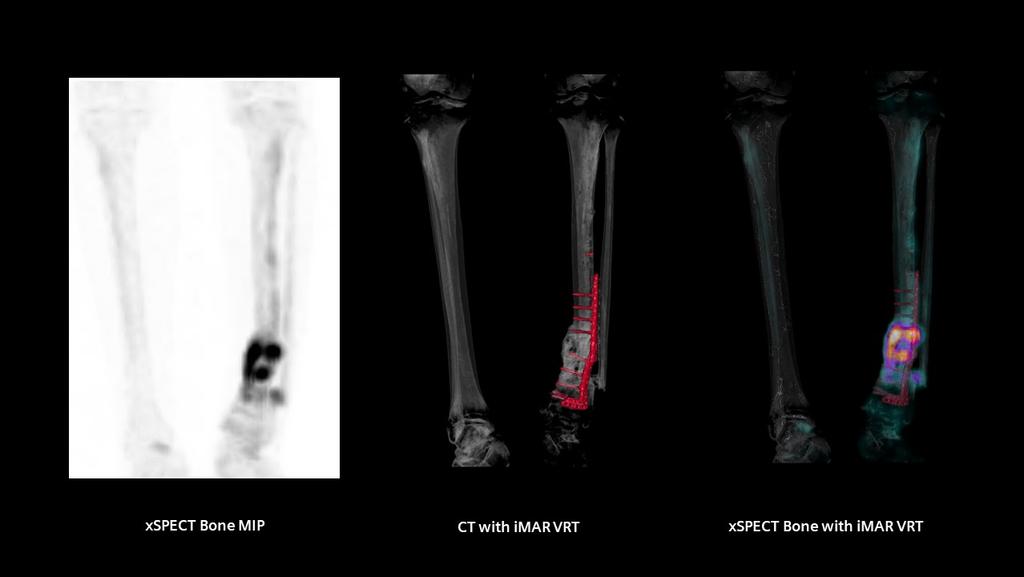 Symbia Pro.specta SPECT/CT - Siemens Healthineers