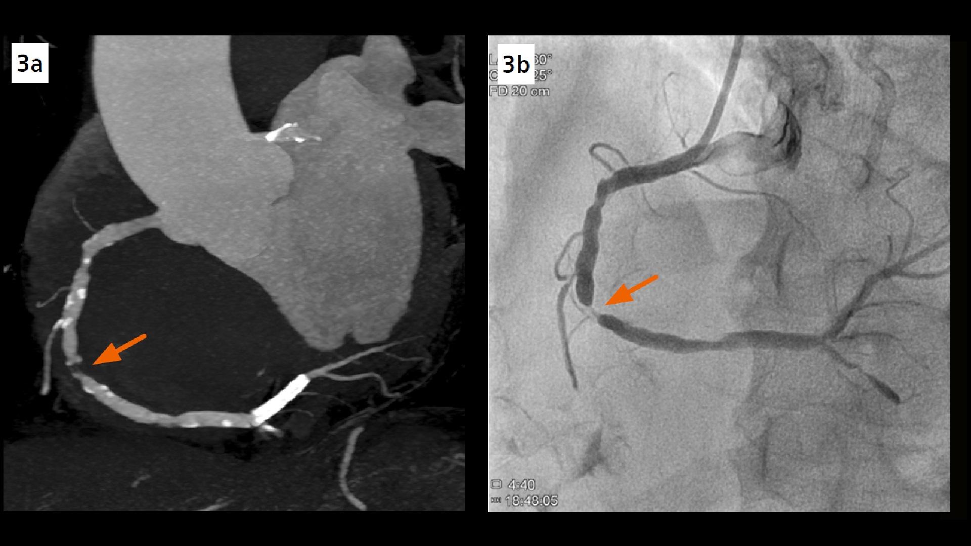 Triple-vessel coronary disease with multiple stents - Siemens Healthineers