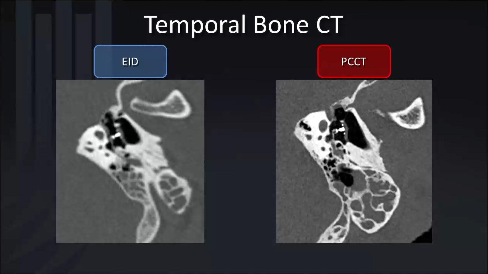 Photon Counting Ct In Neuroradiology Siemens Healthineers Polska