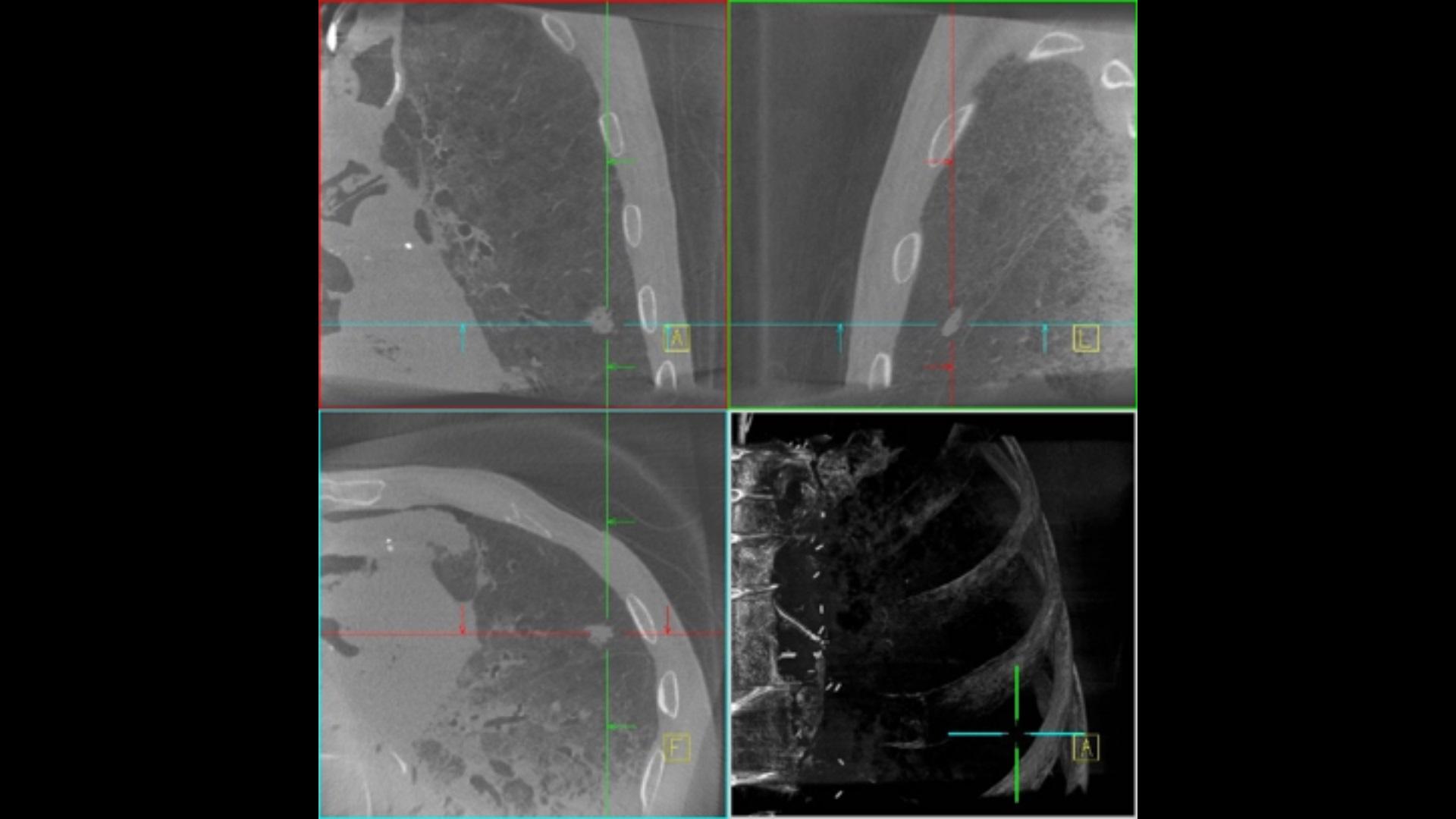 Cios Spin – Mobile C-arm machine - Siemens Healthineers
