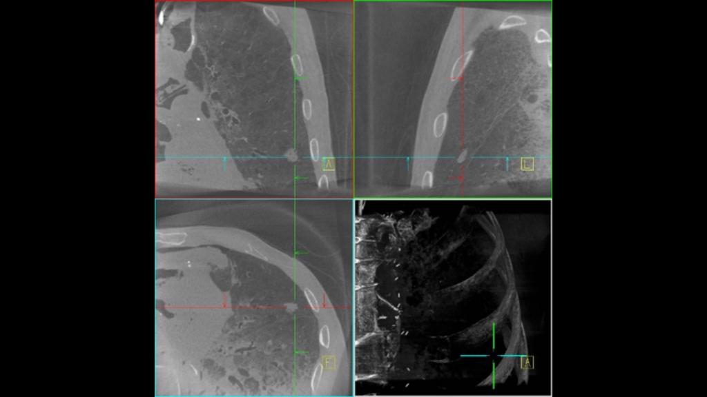 Cios Spin – Mobile C-arm machine