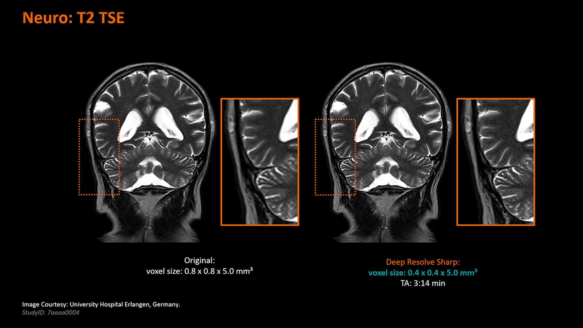 Deep Resolve - Siemens Healthineers