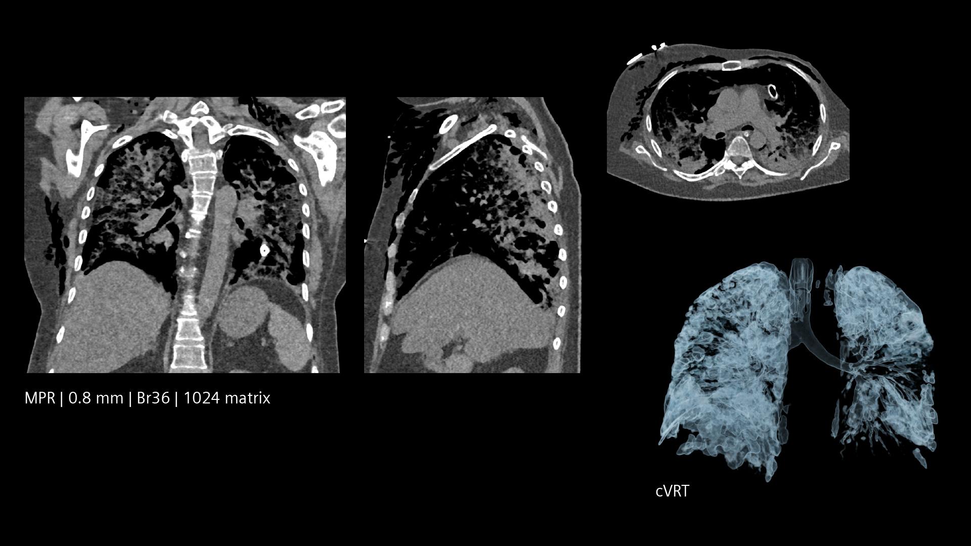 PCCT pulmonology imaging - Siemens Healthineers