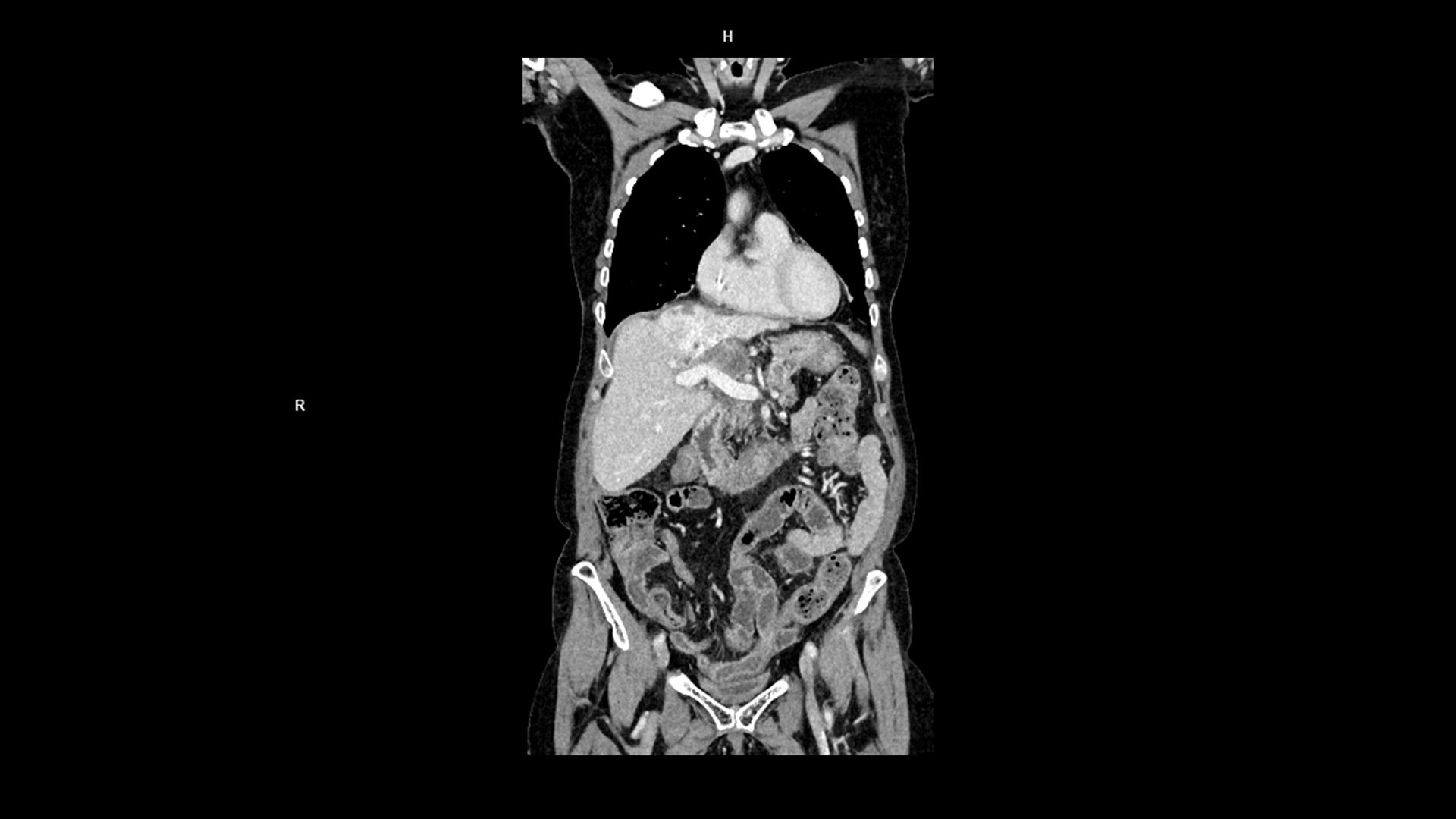 Somatom Pro Pulse Dual Source Ct Scanner Siemens Healthineers