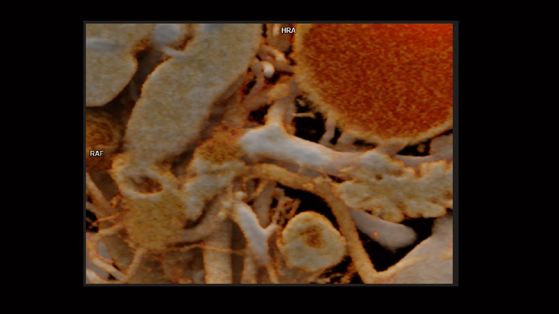 Atypical Pancreatic Neuroendocrine Tumor Secondary To Metastatic Renal