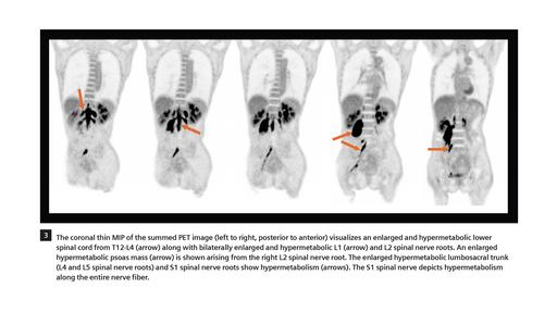 18F FDG PET/CT delineation of diffuse large B-cell lymphoma involving ...