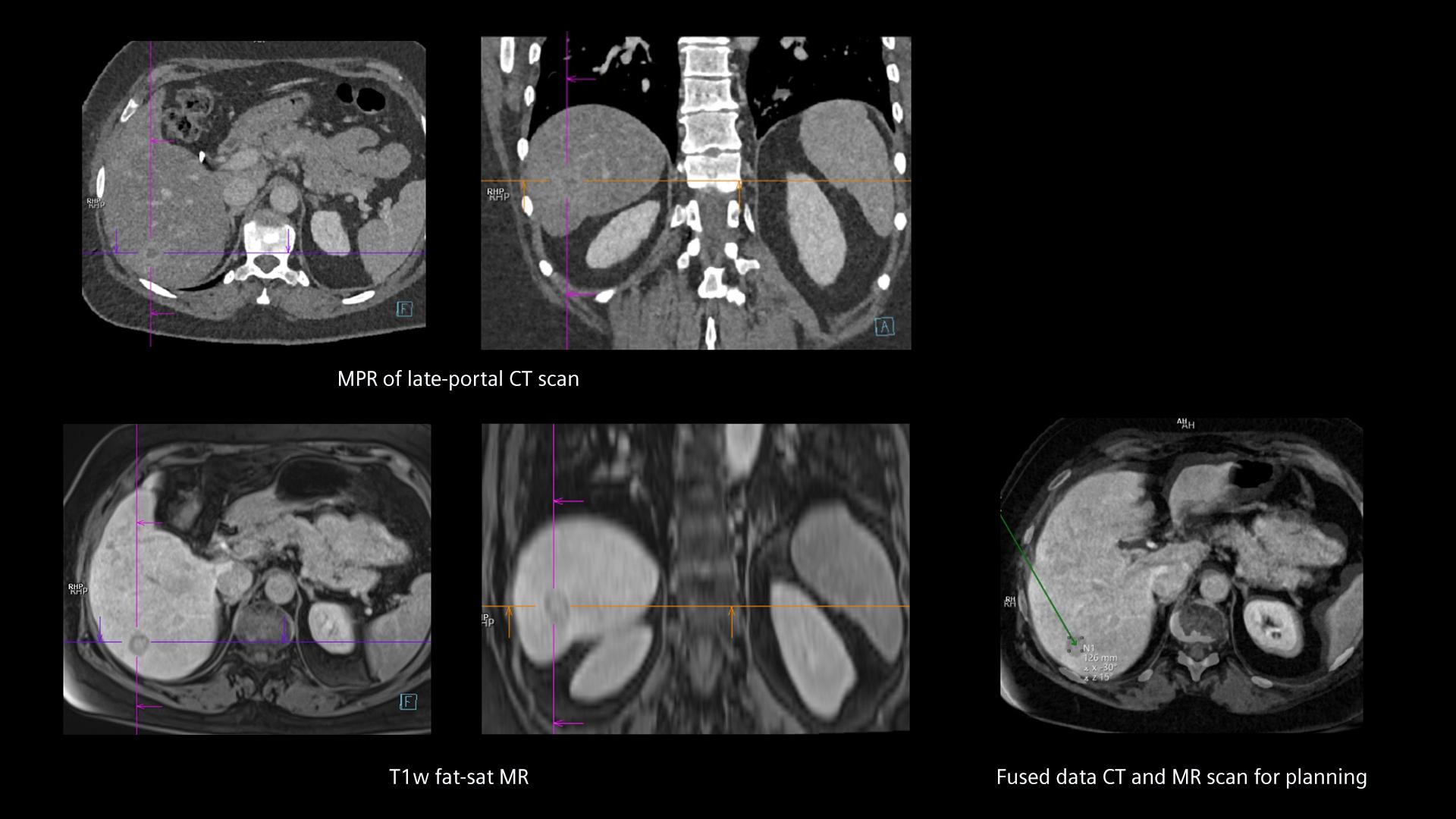 CT-geführte interventionelle Verfahren - Siemens Healthineers Schweiz