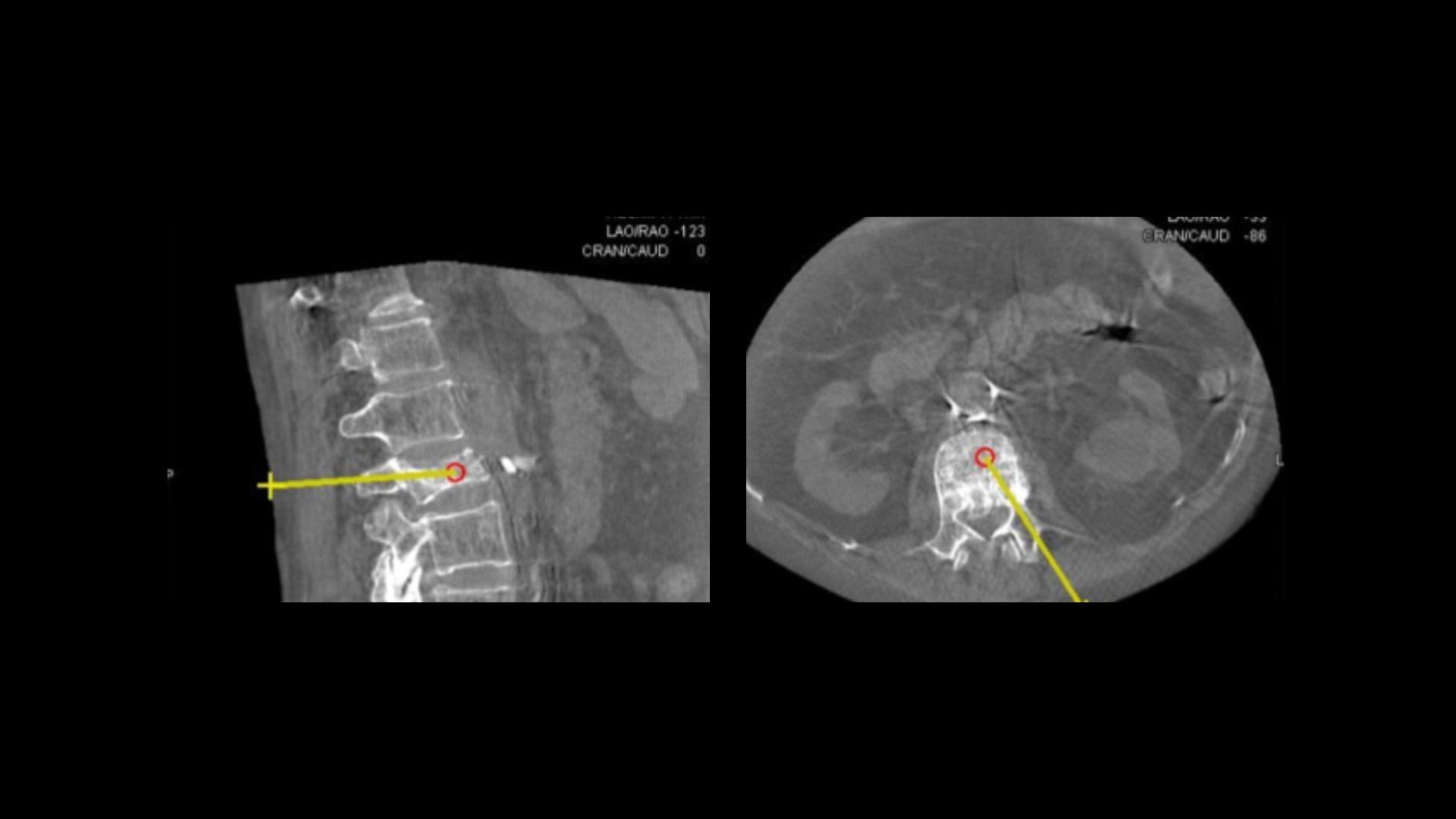ARTIS icono for neuro interventions - Siemens Healthineers USA