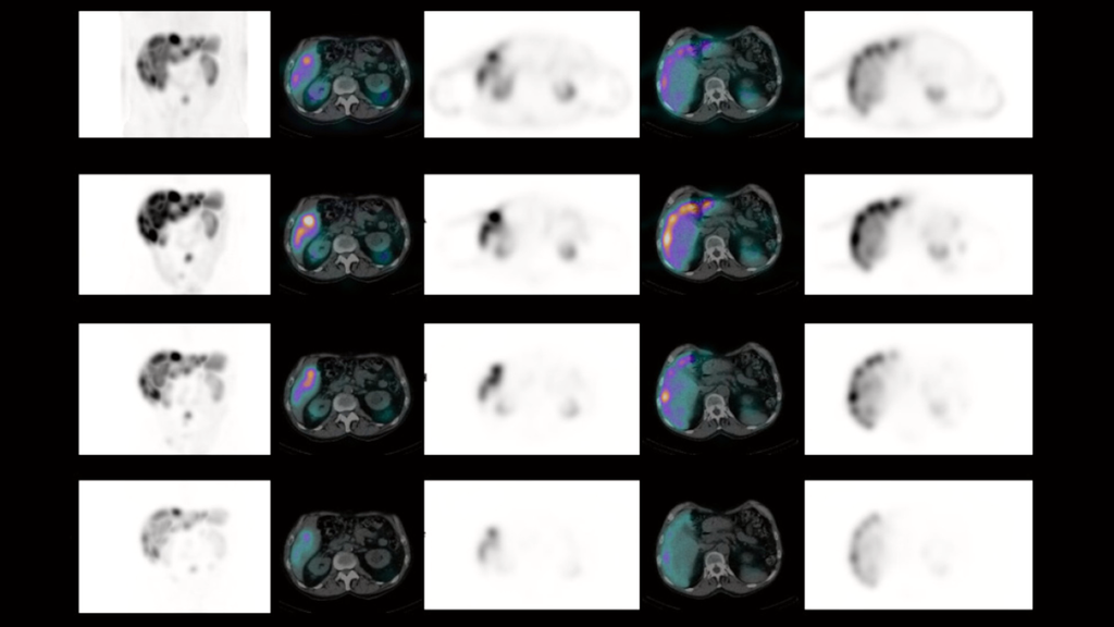 Theranostics for personalized cancer care - Siemens Healthineers